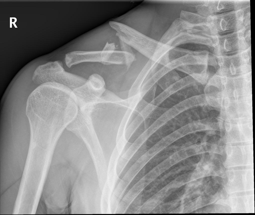 Clavicle Fracture Xray Clavicle Fracture Xray